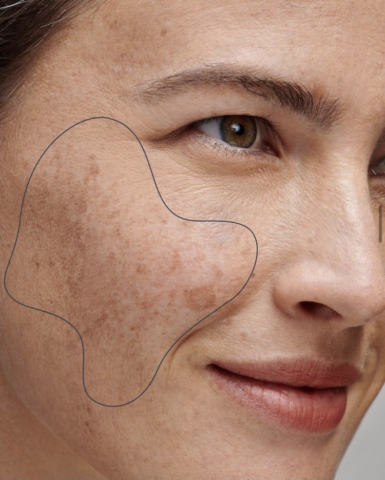 Hyperpigmentation - SKIN Studio and Spa - Les Sables (85).